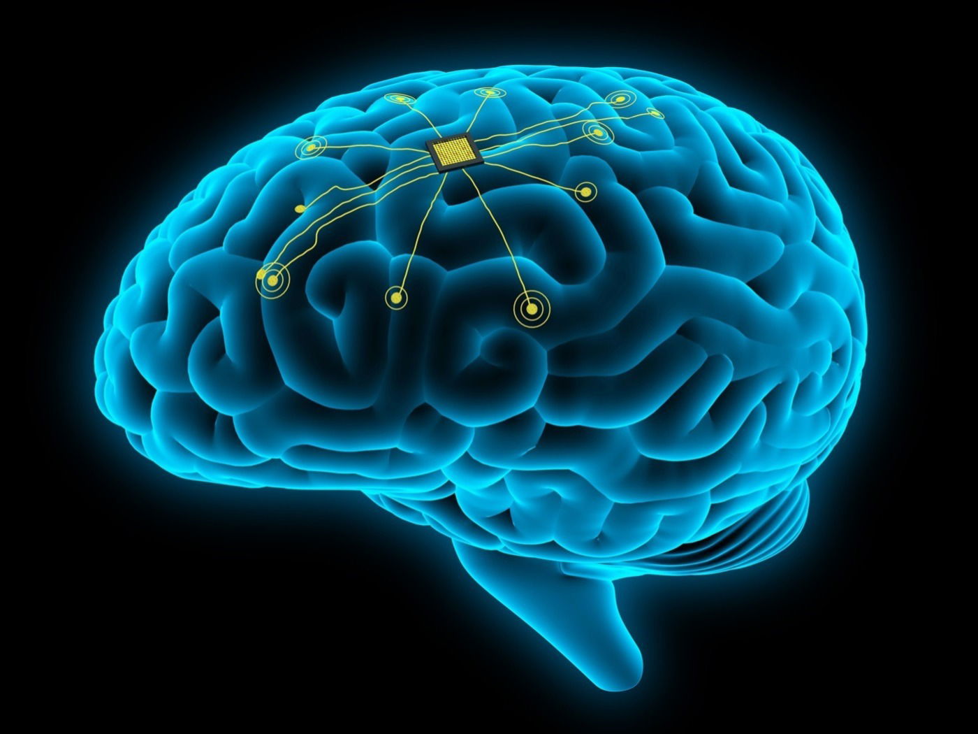 Criança com 1º implante cerebral para epilepsia reduz 80% das ...